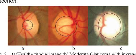 figure 2 from autonomous glaucoma detection from fundus image using cup to disc ratio and hybrid