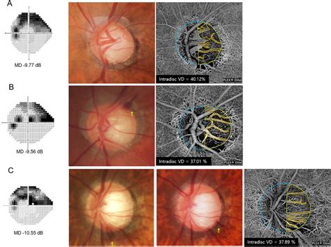representative primary open angle glaucoma eyes with and without optic download scientific
