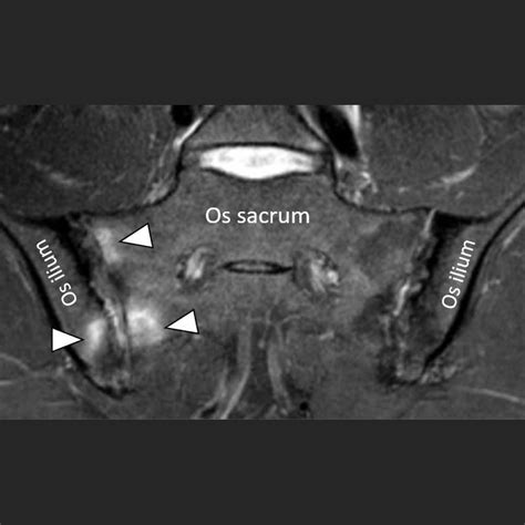 Mrt Isg Iliosakralgelenk Aristra Radiologie Netzwerk