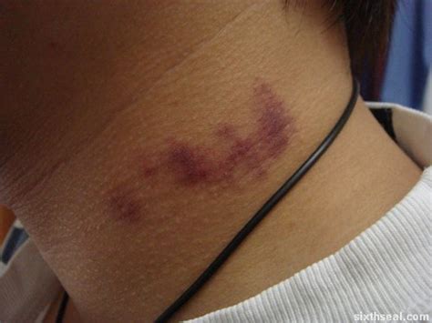 Hickey