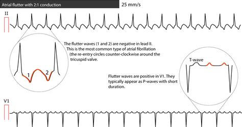 Atrial Flutter Classification Causes Ecg Diagnosis Management