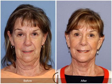 Best Plastic Surgeon For Lower Face Lift At Dolores Huntley Blog