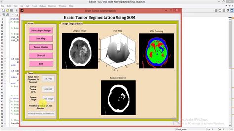 matlab project for brain tumor detection using watershed segmentation methods tumor