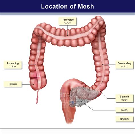 Location Of Mesh Near Rectum And Sigmoid Colon TrialExhibits Inc