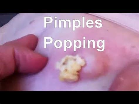 Pimples Popping Acne Popping Newvideo Compilation Youtube