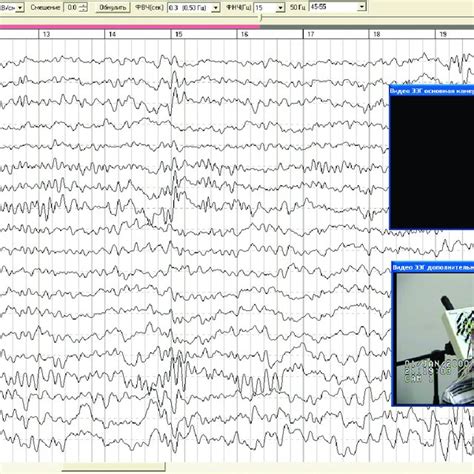 А video eeg monitoring multifocal epileptic activity predominantly download scientific