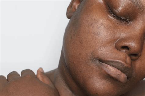 Do You Know The Difference Between Hyperpigmentation And Melasma