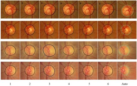optic disc segmentation for glaucoma screening system using fundus ima opth