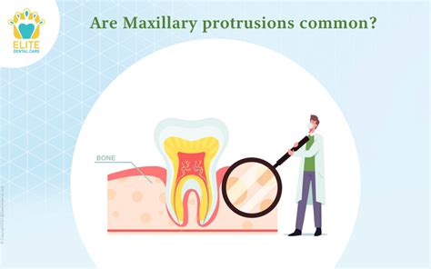 Difference Between Maxillary And Mandibular Premolars Archives Elite