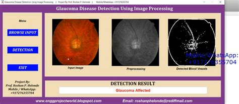 glaucoma detection using image processing matlab project with source code final year project