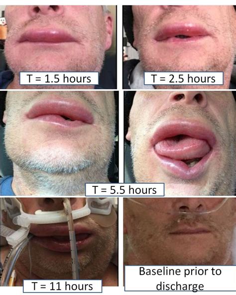 How To Treat Allergy Around Lips Ppt