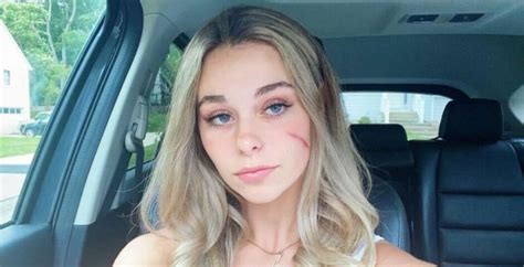 Everything The Tiktok Scar Girl Has Said About Her Facial Scar