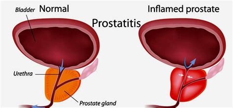 Prostate Massage Therapy Technique Prostate Health Center