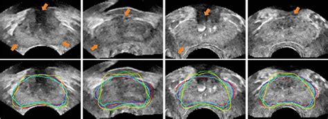 visual comparison of prostate segmentation results top row prostate download scientific