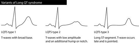 Long QT QTc Interval Long QT Syndrome LQTS Torsades De Pointes
