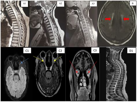 A1 Sagittal T2 Weighted Mri Of Case Ones Cervical And Thoracic Spine Download Scientific