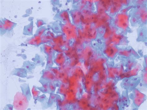 What Is Trichomoniasis Causes Symptoms Treatment Evvy