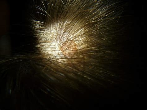 Scalp Folliculitis Types And Remedies Nourishdoc