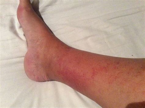 Causes Of Venous Stasis Dermatitis