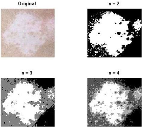 results of skin lesion segmentation by using otsu s thresholding method download scientific