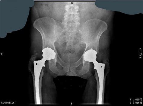 I M Told My Metal Hips Qualify Me To Post Here R HumansAreMetal