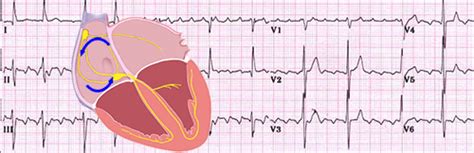Arritmias Cardiacas The Best Porn Website