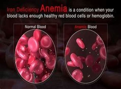 Iron Deficiency Anemia Symptoms Signs You Might Want To Know Warm And Tote
