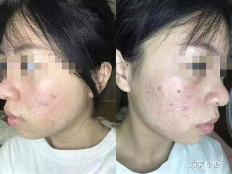 点阵激光去痘坑痘印效果好吗价格贵吗看完这篇保你不再踩坑 附痘坑案例 知乎