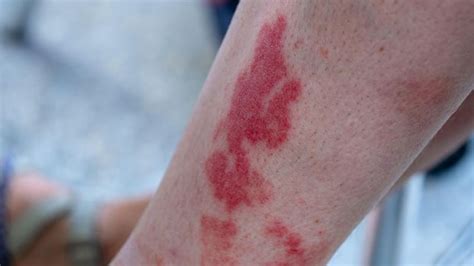 Leukemia Rash Pictures Signs And Symptoms Everyday Health