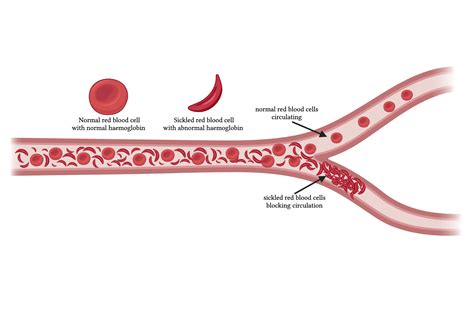 RBC In Sickle Cell Anemia BioRender Science Templates