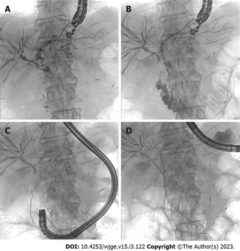 Endoscopic Ultrasound Guided Biliary Drainage In Surgically Altered