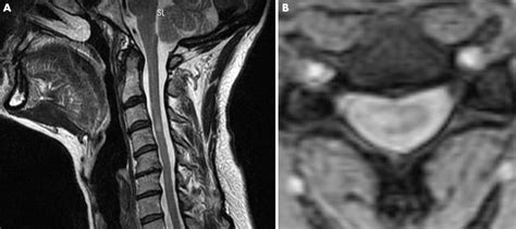 Imaging In Multiple Sclerosis Journal Of Neurology Neurosurgery And Psychiatry