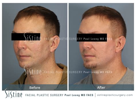 Phoenix Co2 Before And After 01 Sistine Facial Plastic Surgery