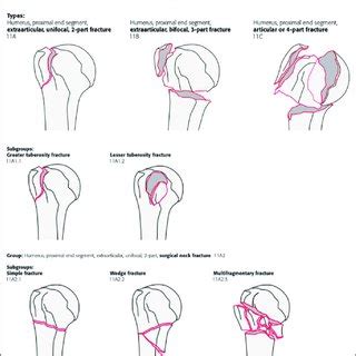 Ao Klassifikation Distale Humerus Hot Sex Picture