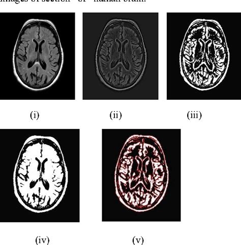 figure 2 from a combination of bias field corrected fuzzy c means and level set approach for