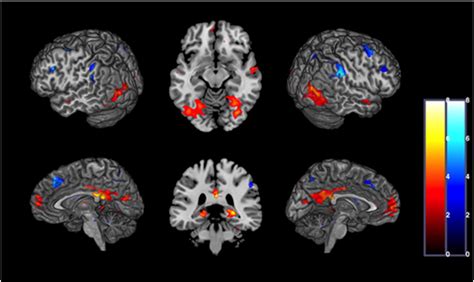 brain activation contrast between visual recursion task vrt and download scientific diagram